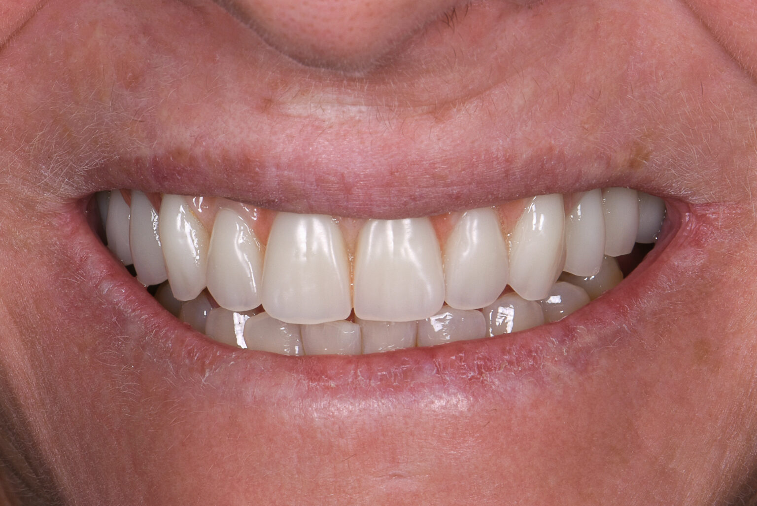 All-On-4® Brisbane | All-On-4® Dental Implants Brisbane | My Implant ...