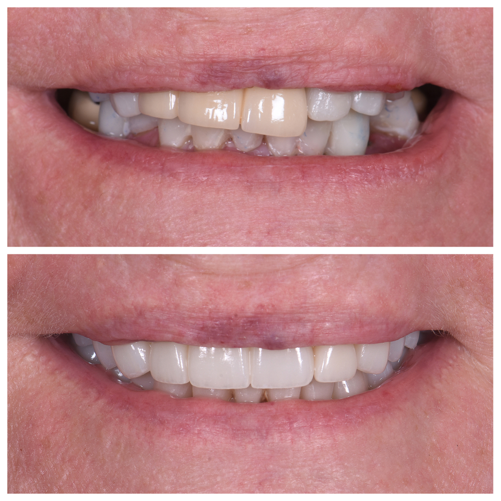 Dental Veneers Brisbane - Affordable Porcelain Veneers Treatment Options