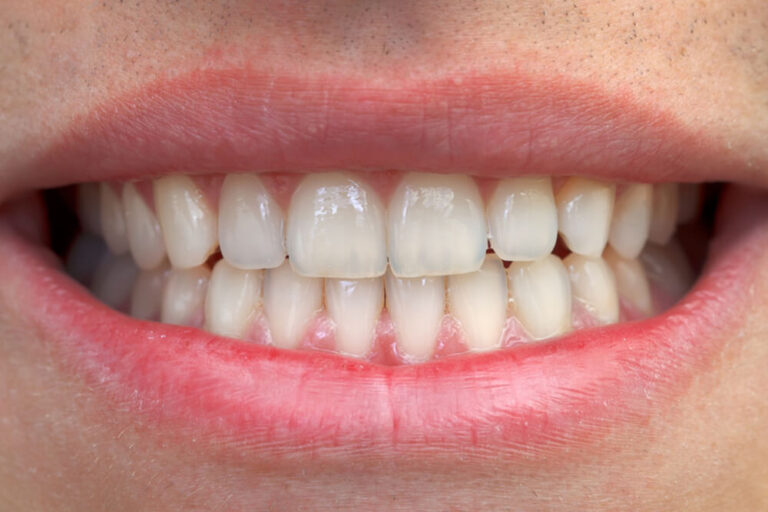 Translucent Teeth - Causes, Treatment & How To Fix It
