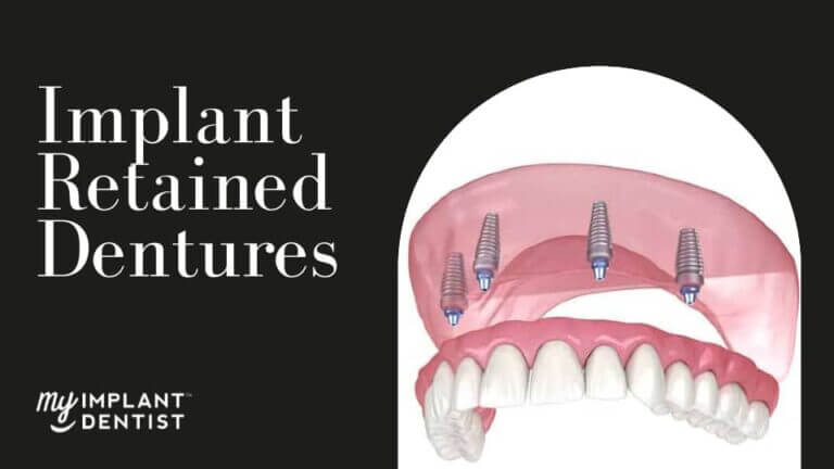 Implant Retained Dentures Perth | My Implant Dentist