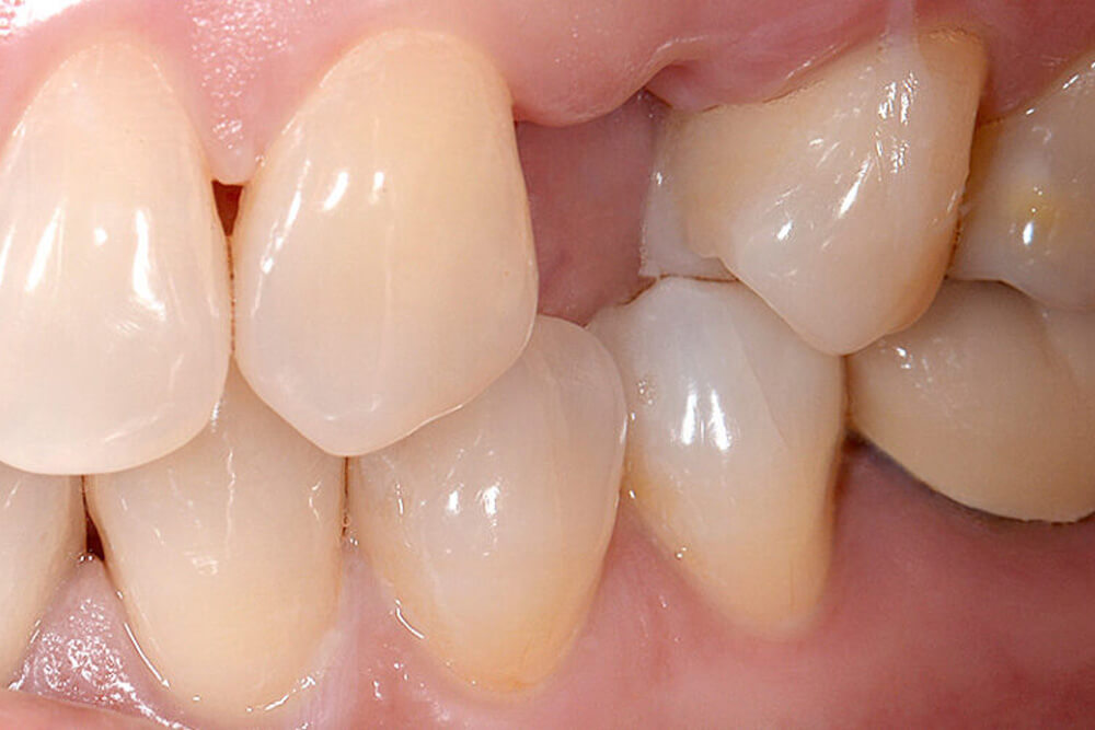 Consequences of Missing Teeth - Perth Dental Implant Clinic