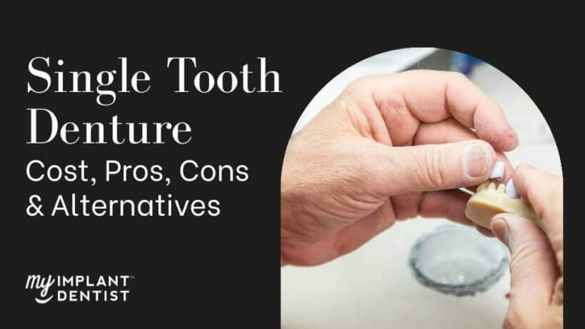 Single Tooth Denture: Cost, Pros, Cons & Alternatives - My Implant Dentist