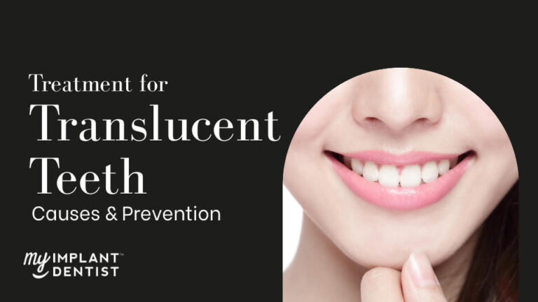 Translucent Teeth - Causes, Treatment & How To Fix It