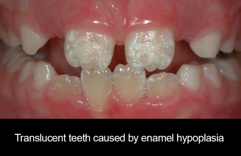 Translucent Teeth - Causes, Treatment & How To Fix It