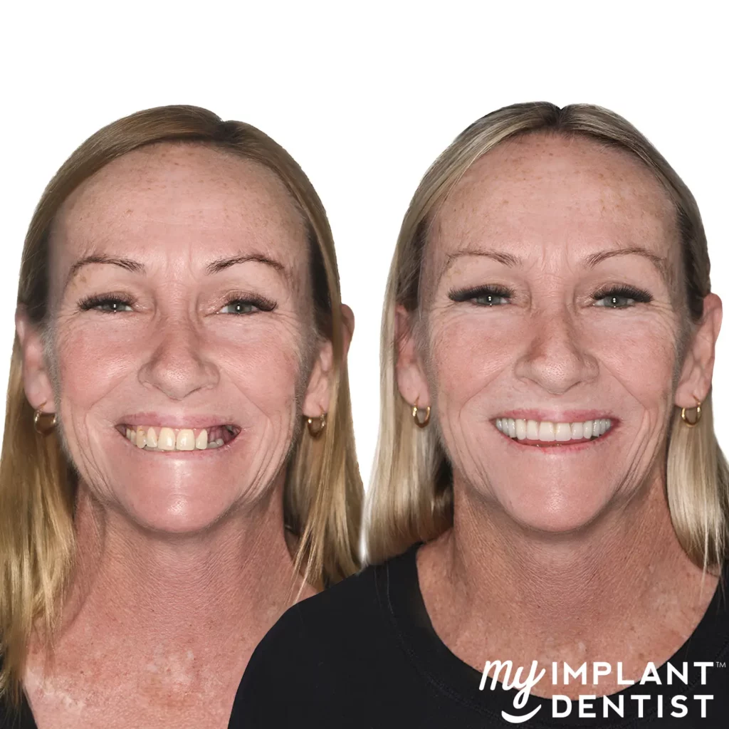 The Ultimate 2025 Guide to Dental Implants in Melbourne: Costs, Process ...